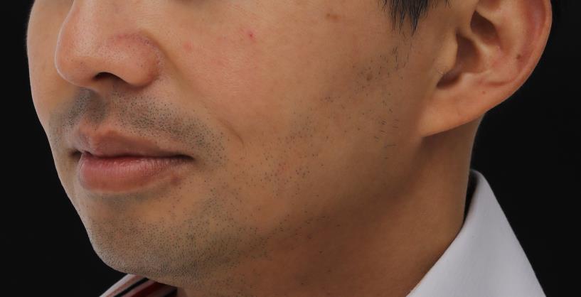 Thermage FLX Skin Tightening Melbourne | EzySkin